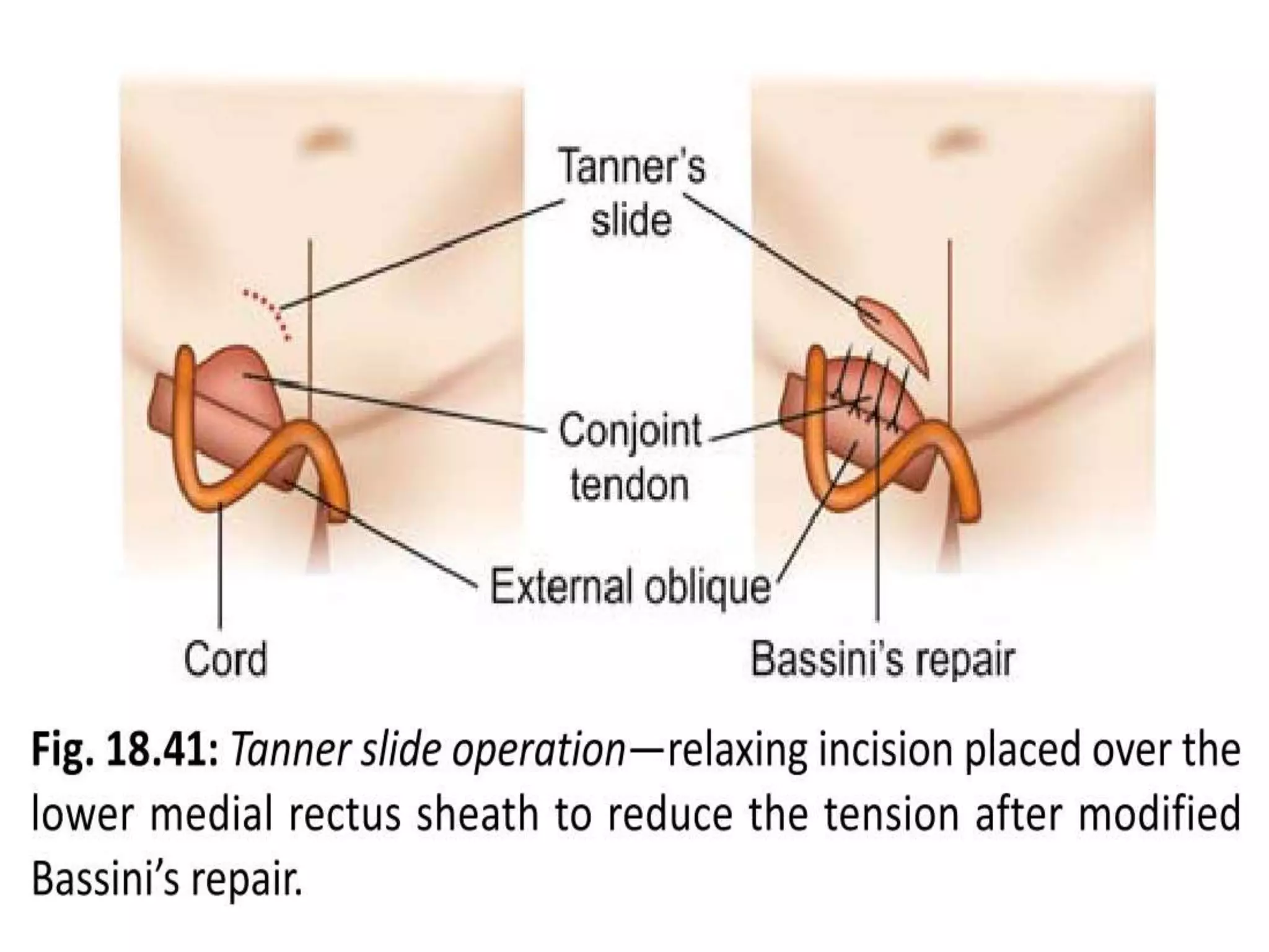 Inguinal Hernia Repair Pptx 0771