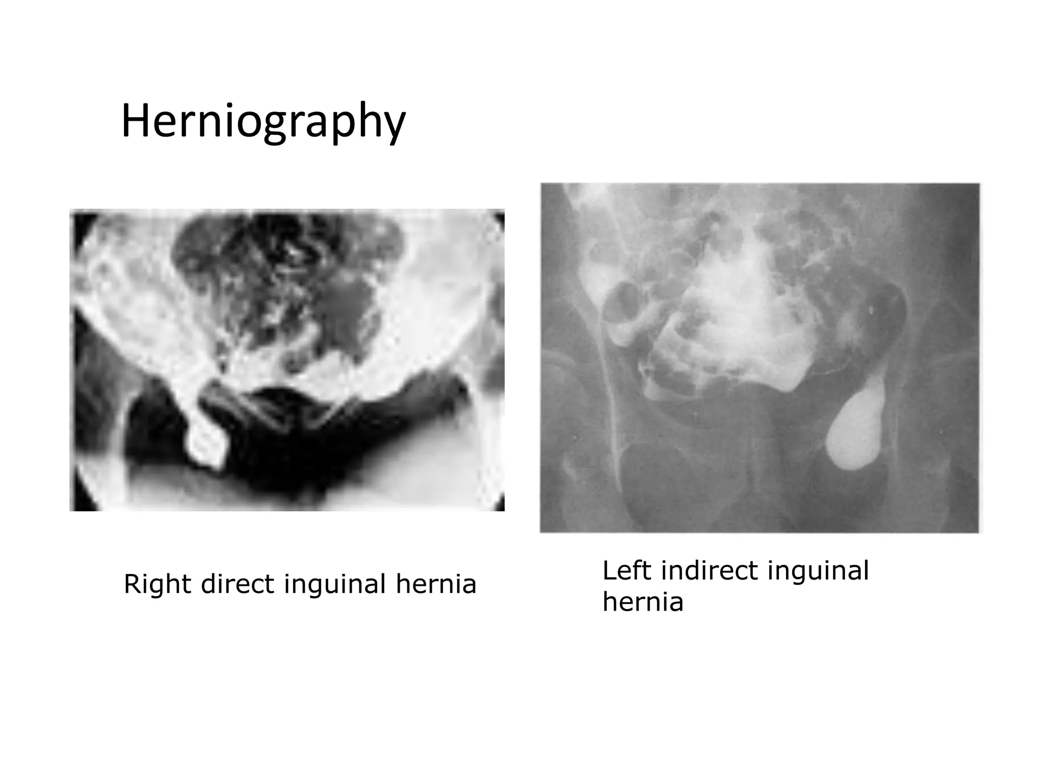 Inguinal hernia repair | PPTX