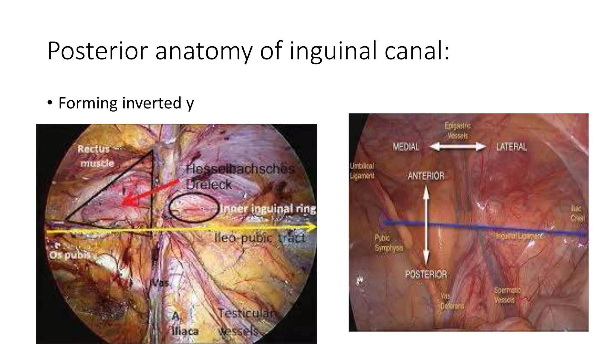 Inguinal Hernia | PPTX