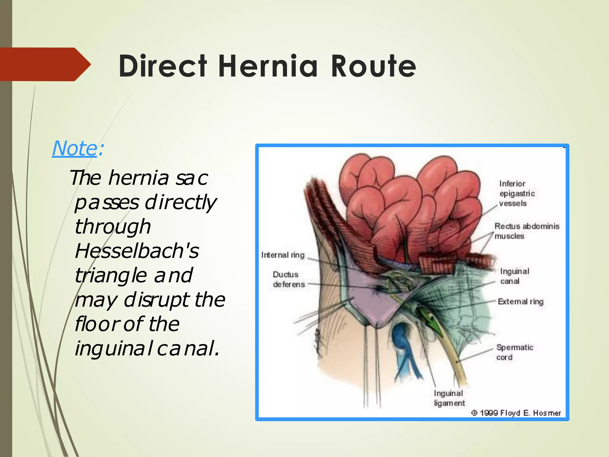 Inguinal hernia repair surgery dr valeria simone southlake general ...