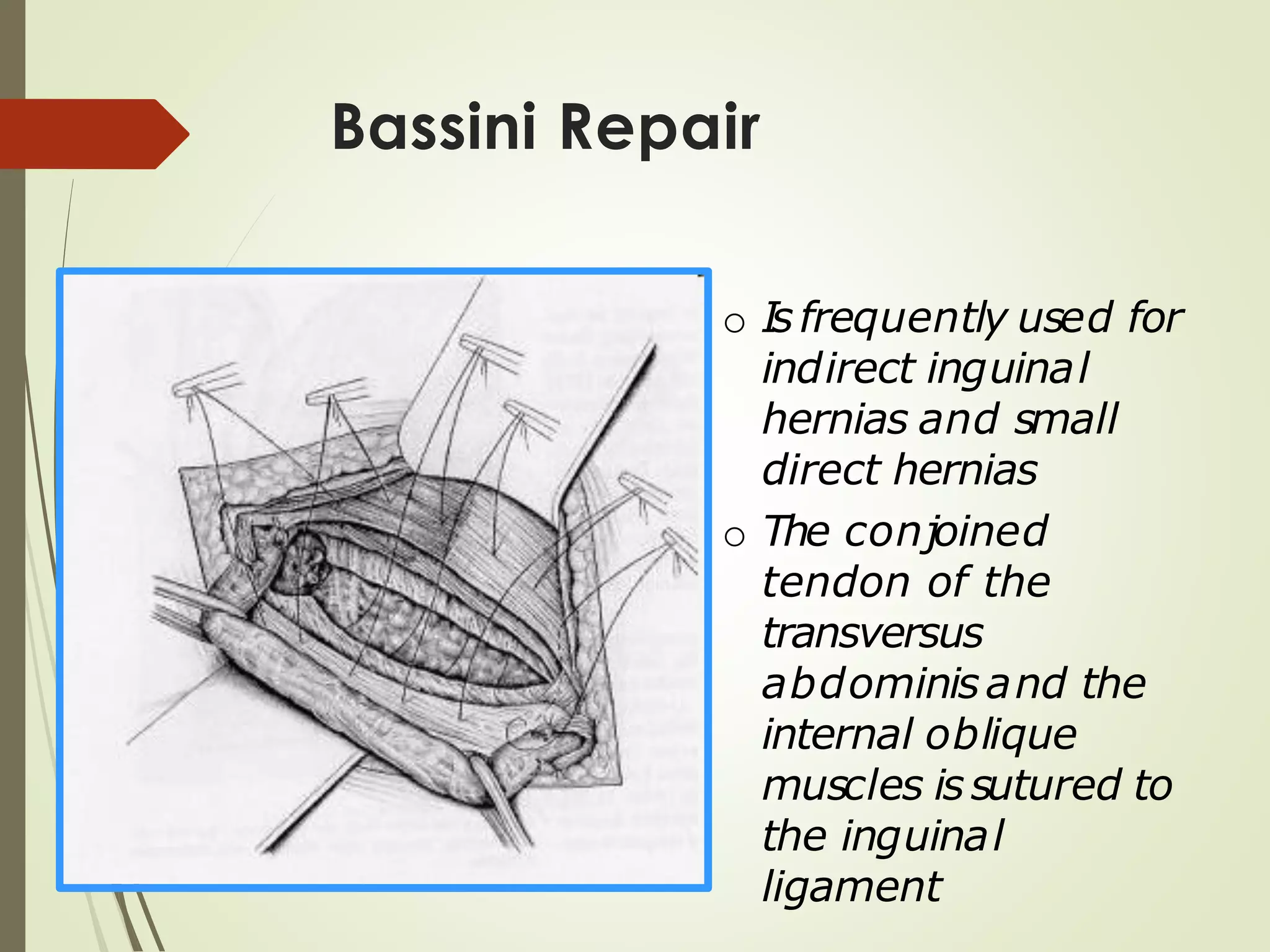 Inguinal hernia repair surgery dr valeria simone southlake general ...