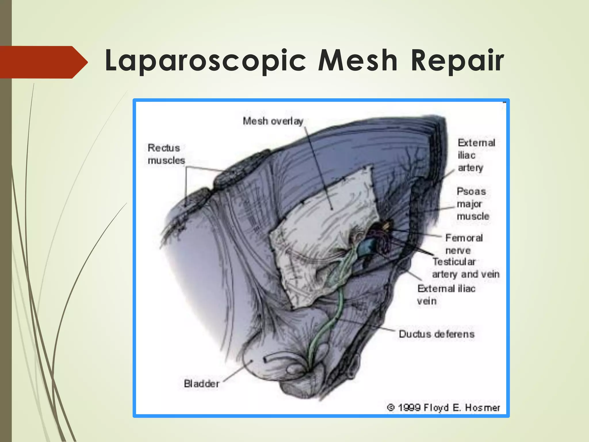 Inguinal hernia repair surgery dr valeria simone southlake general ...