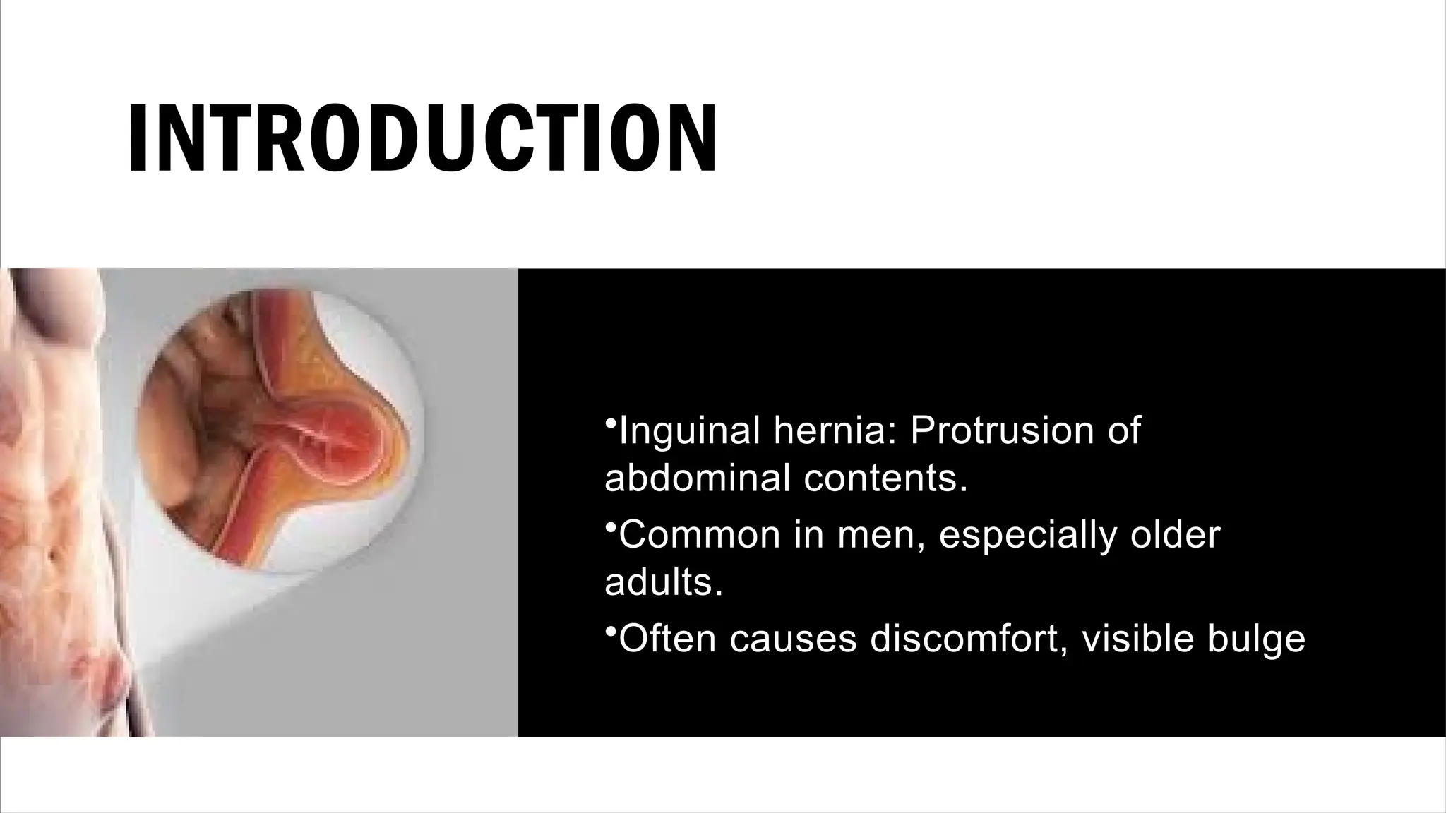 Inguinal Hernias simra sem1 presentation | PPTX