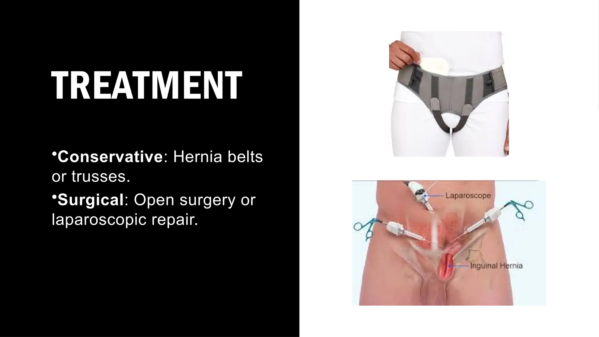Inguinal Hernias simra sem1 presentation | PPTX