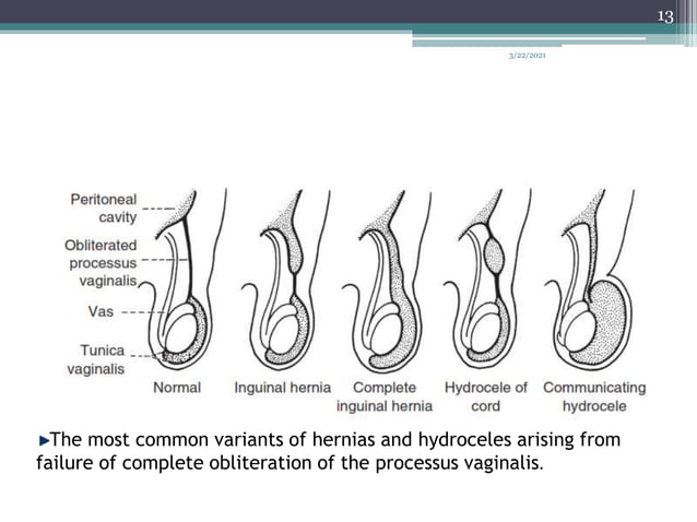 Inguinal hernias in pediatrics | PPTX