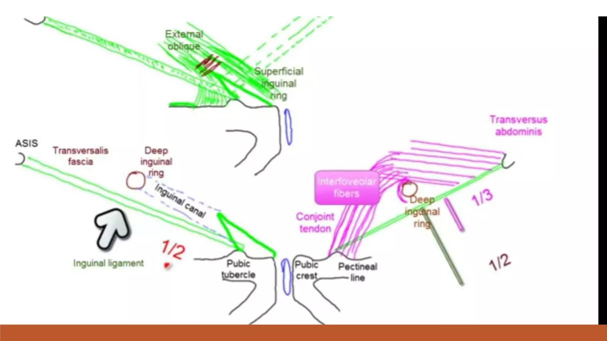 Inguinal hernia surgery | PPTX