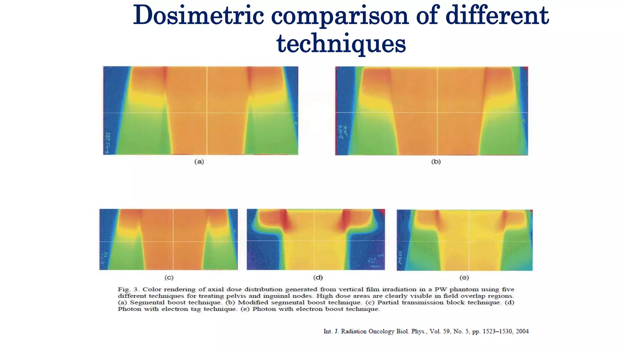 Techniques for Inguinal/Groin Irradiation | PPTX