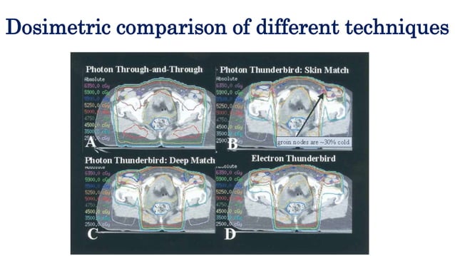 Techniques for Inguinal/Groin Irradiation | PPTX | Physical Therapy ...