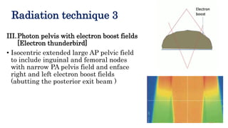 Techniques for Inguinal/Groin Irradiation | PPTX
