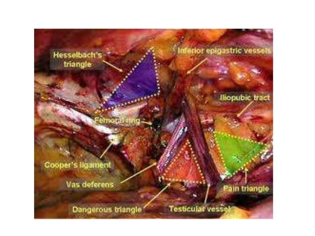 Inguinodynia by Prof. Ajay Khanna, IMS, BHU, Varanasi, India | PPT