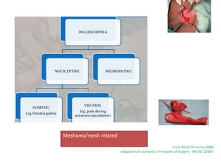 Inguinodynia by Prof. Ajay Khanna, IMS, BHU, Varanasi, India | PPTX