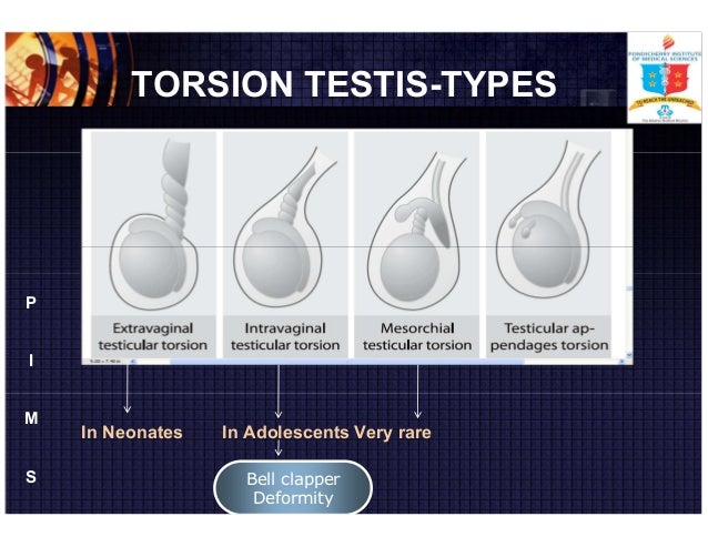 Inguinoscrotal swellings- a problem oriented approach