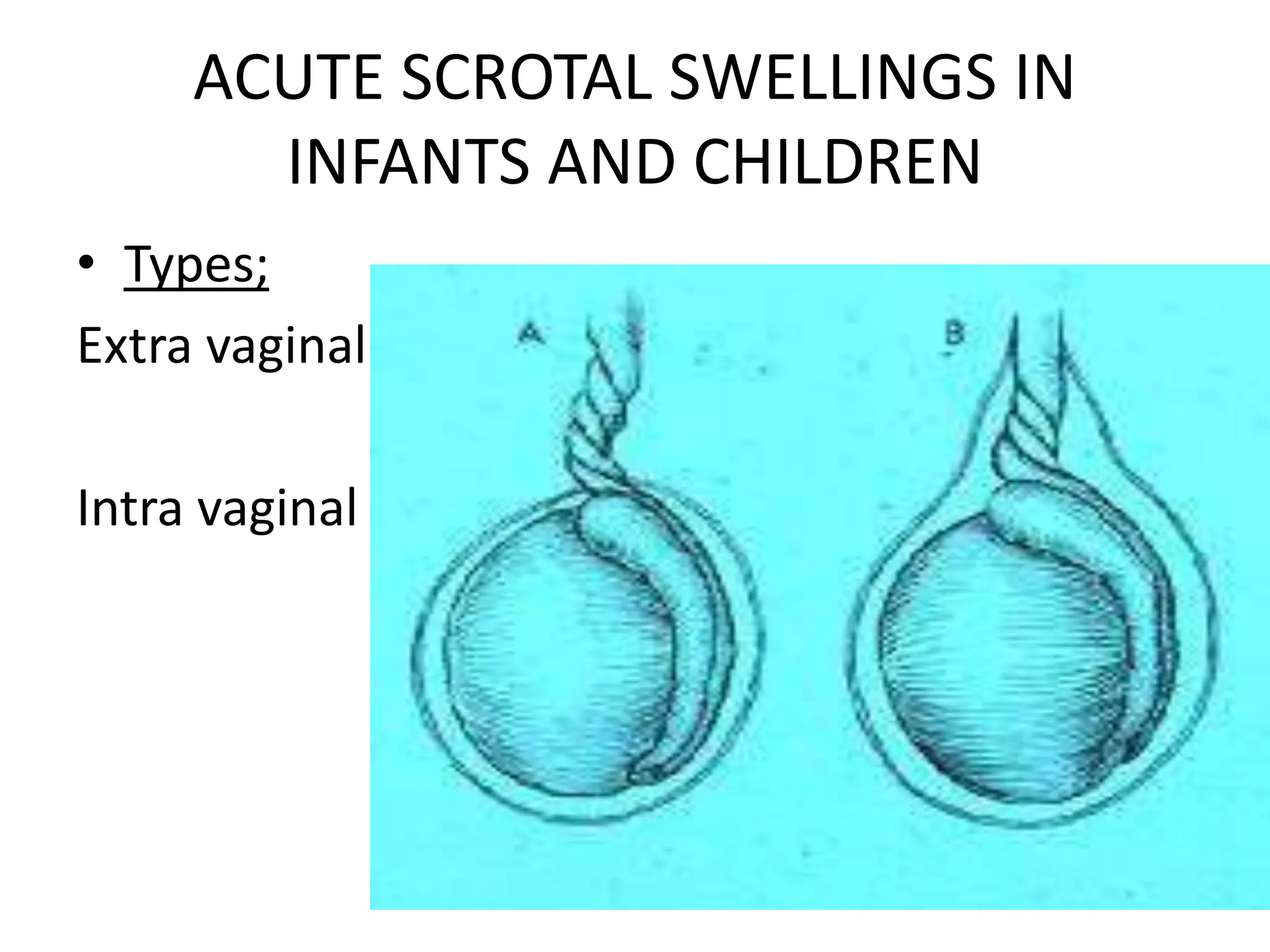 Inguinoscrotal swellings & Acute scrotum | PPTX