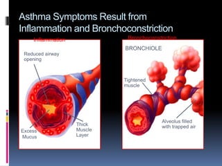 Inhalars for bronchial asthma | PPTX