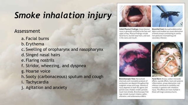 INHALATION-INJURY nursing lesson to prevent complications | PPTX