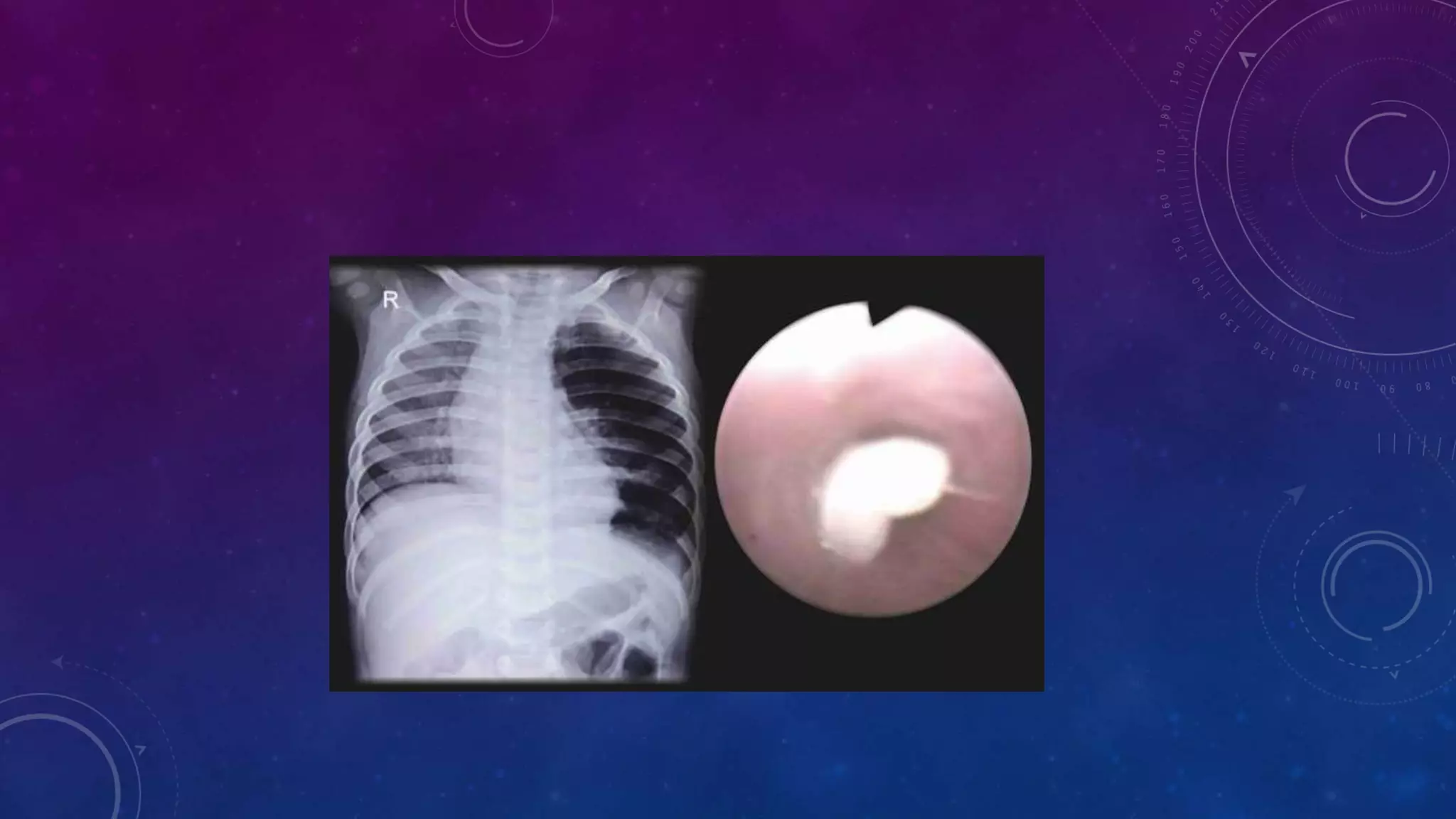 Inhaled foreign body.pptx