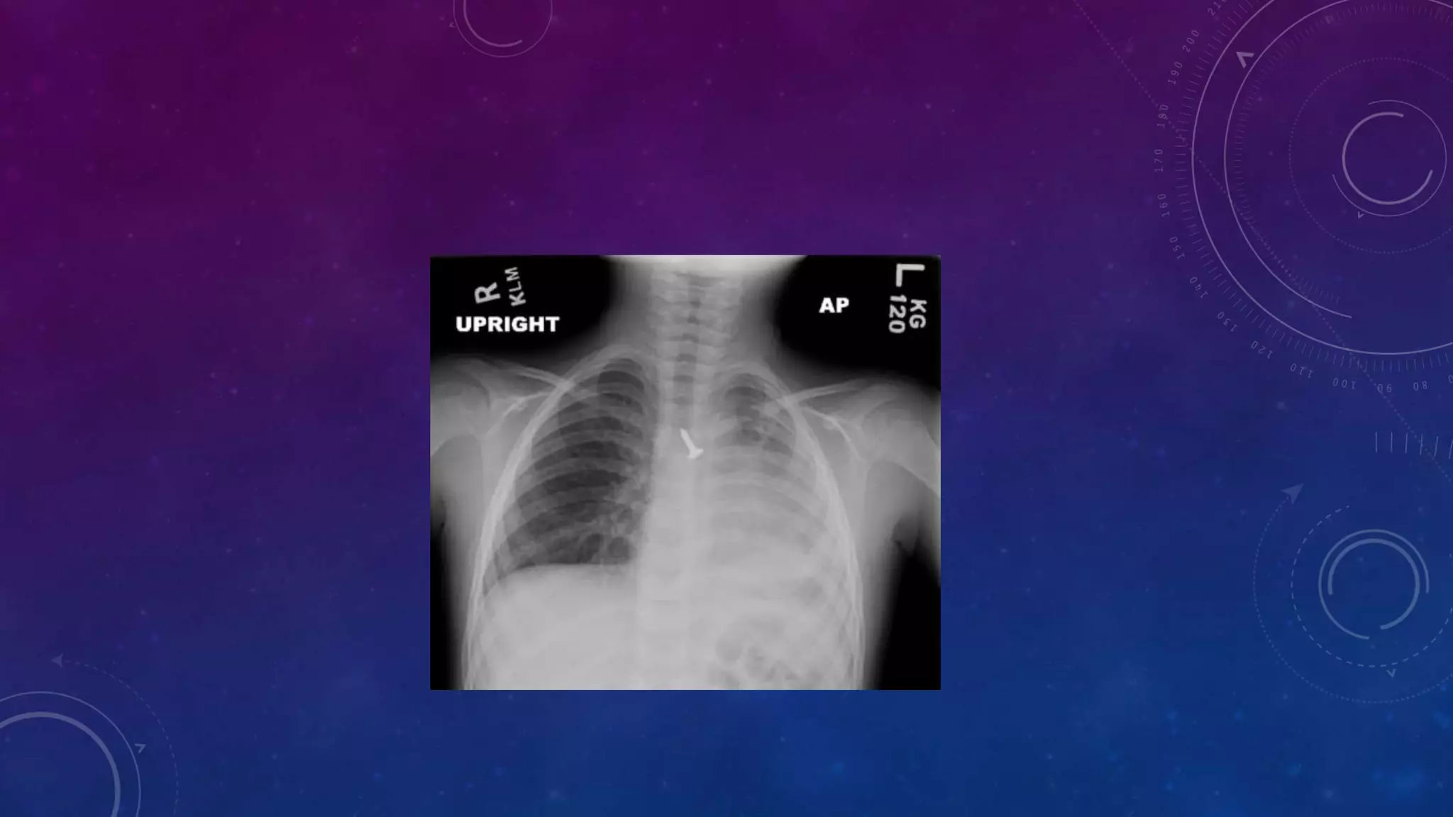 Inhaled foreign body.pptx