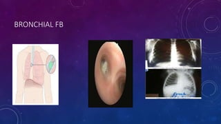 Inhaled foreign body.pptx