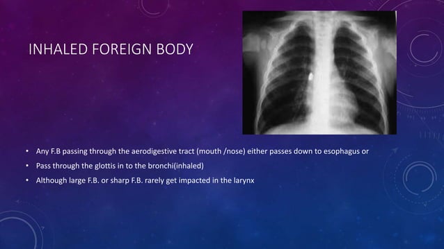Inhaled foreign body.pptx | Ear, Nose and Throat Conditions | Diseases ...