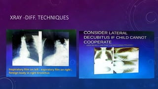 Inhaled foreign body.pptx