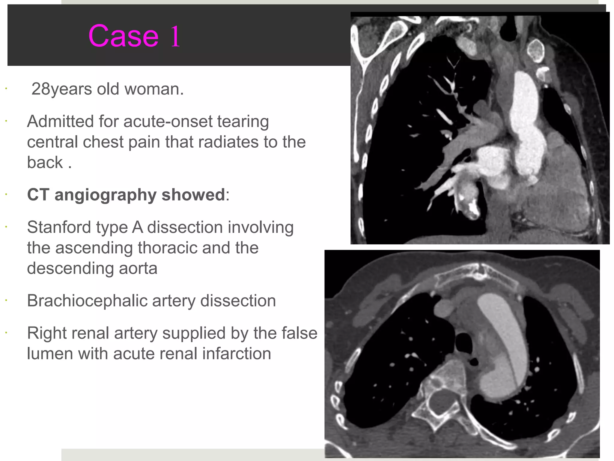 Inherited aortopathy2022 | PPTX
