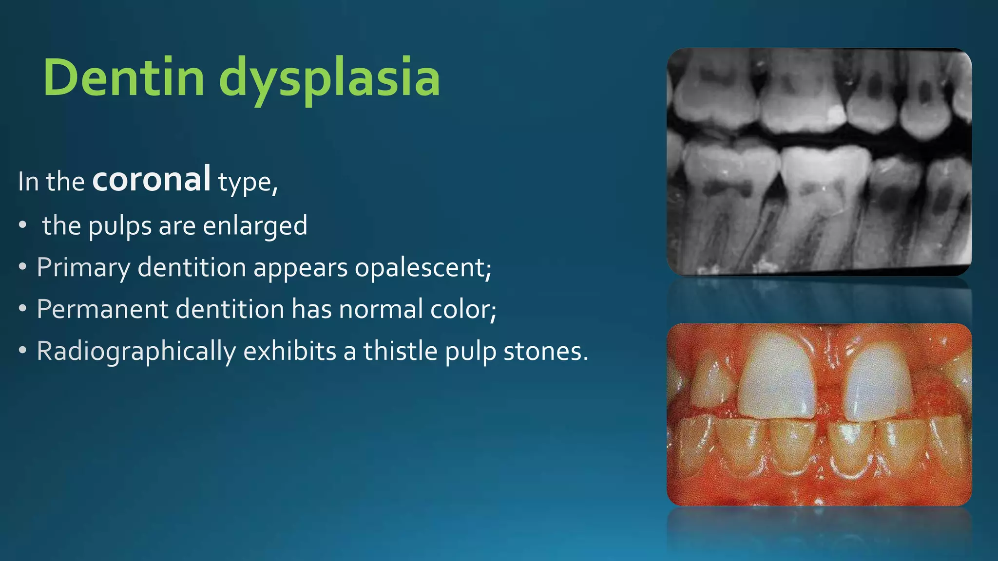 Inherited dentin defects (Dentistry) | PPTX