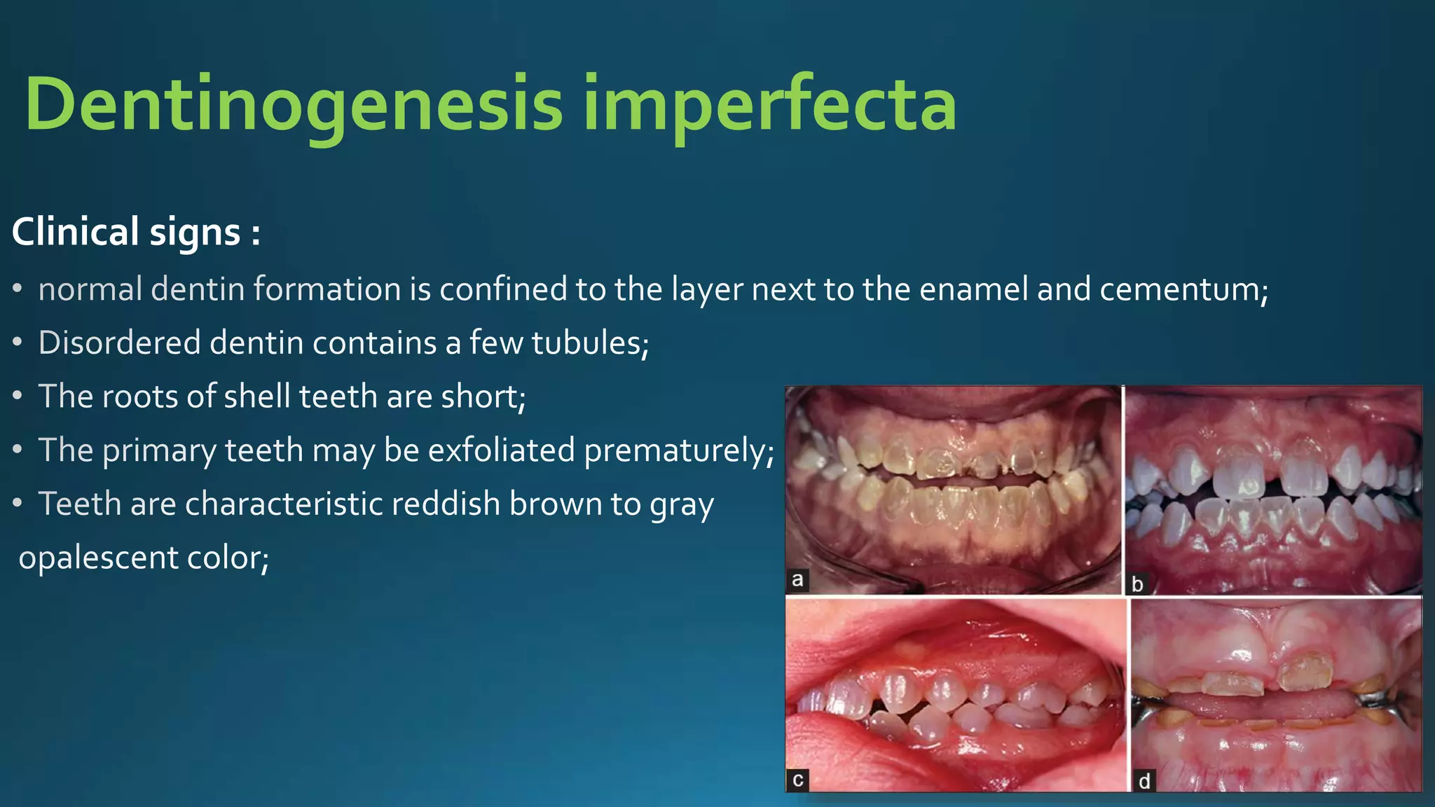 Inherited dentin defects (Dentistry) | PPTX
