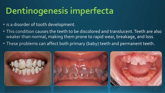 Dentin Dysplasia Vs Dentinogenesis Imperfecta