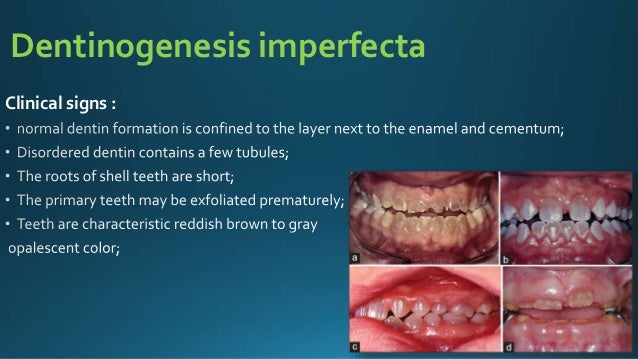 Inherited dentin defects (Dentistry)