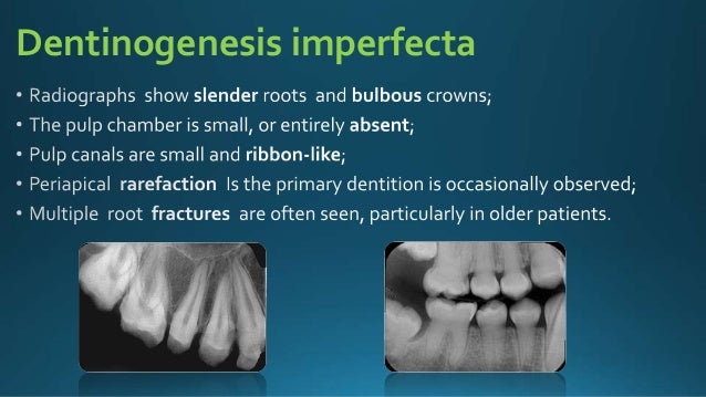 Dentin Dysplasia Vs Dentinogenesis Imperfecta