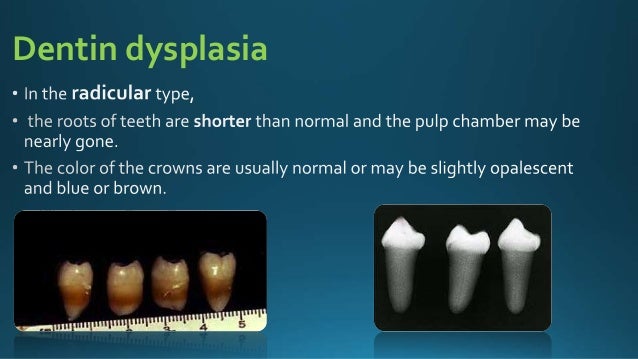 Dentin Dysplasia Vs Dentinogenesis Imperfecta