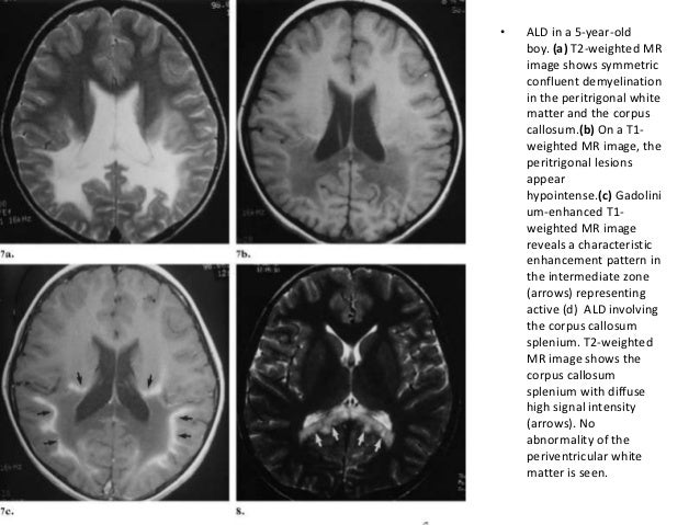 Inherited white matter diseases