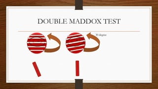 Maddox rode | PDF | Eye and Vision Conditions | Diseases and Conditions