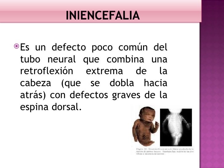 Iniencefalia