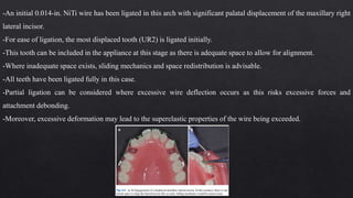 Initial alignment in orthodontic treatment (dr nayaungbds phd) | PPTX
