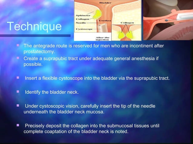 Injectable materials for stress incontinence in males | PPT