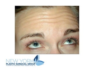 Nonsurgical Facial Rejuvenation: Botox and Facial Fillers | PDF