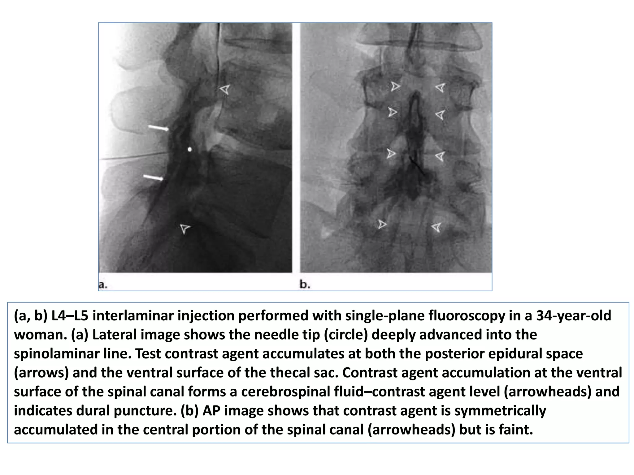 Injection in spine | PPTX