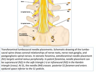 Injection in spine | PPTX