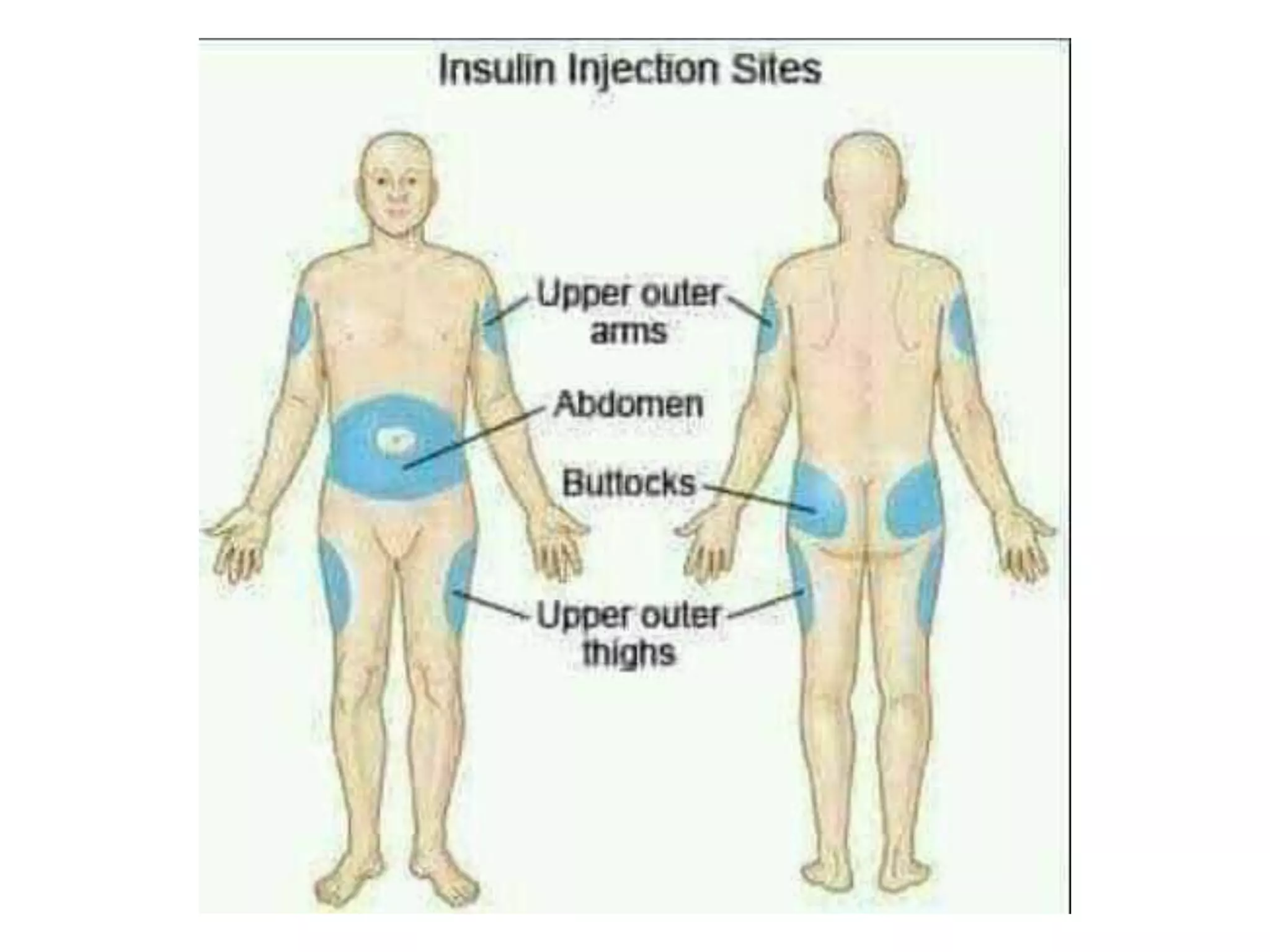 injectiontechnique.pptx