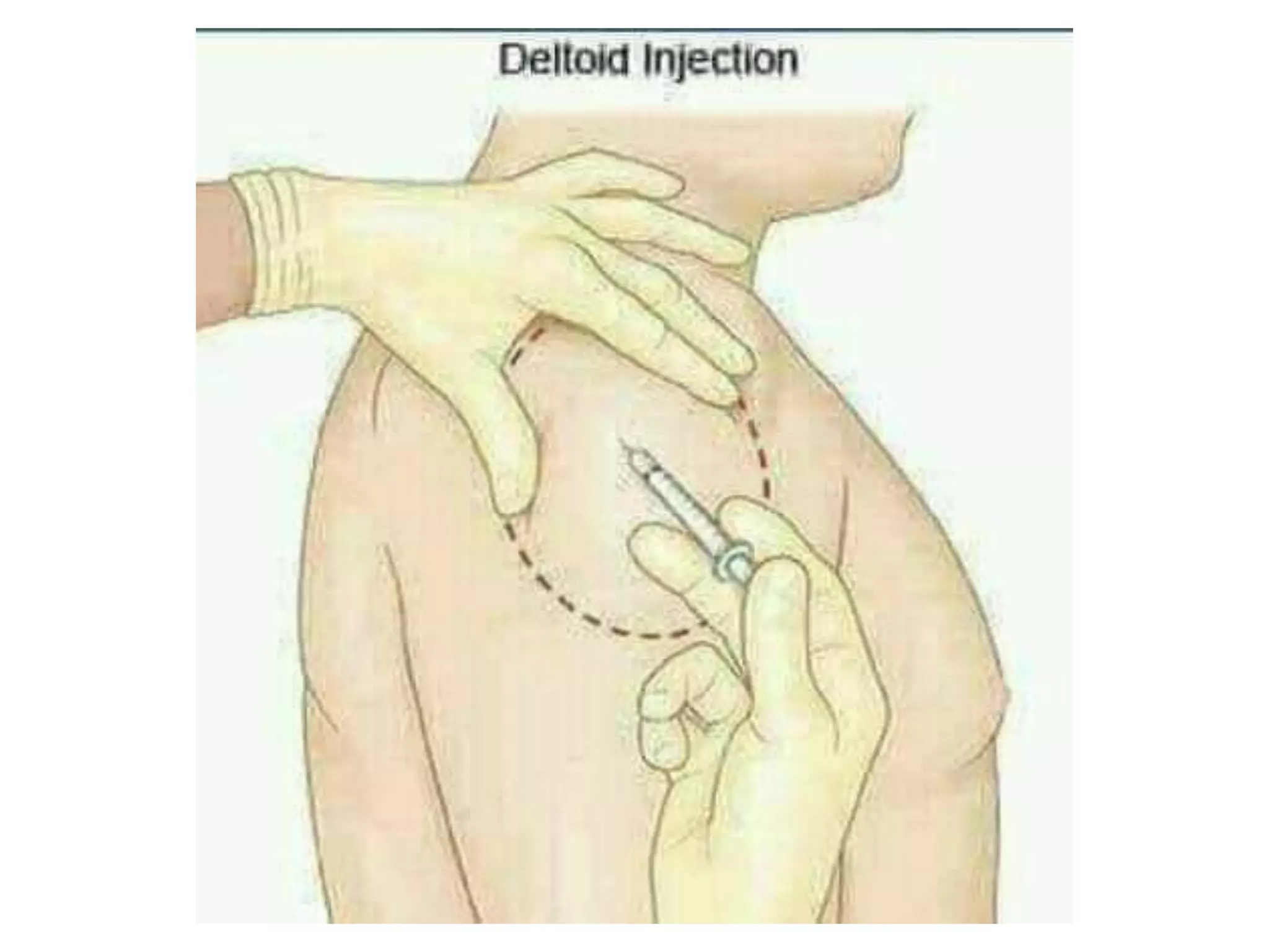 injectiontechnique.pptx