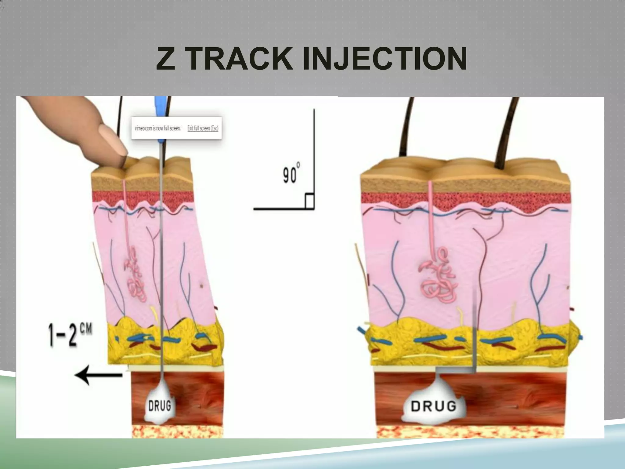 Injection Technique | PPTX