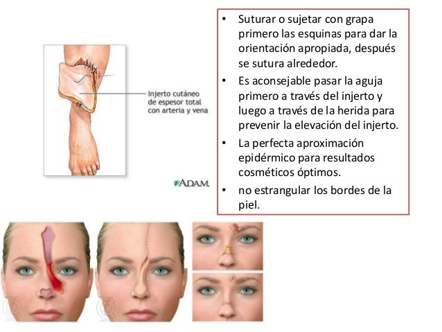 Injerto de piel completo