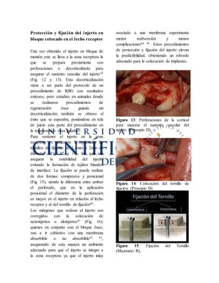 Injerto óseo de mentón: artículo de revision | DOCX