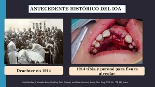 Injerto Oseo Alveolar | PPTX