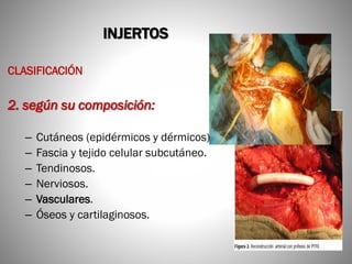 Injertos | PPTX