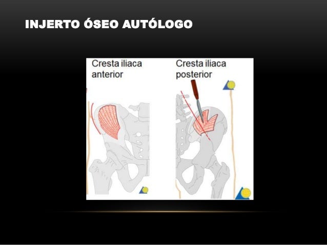 Injertos Óseos en Criugía Ortopédica