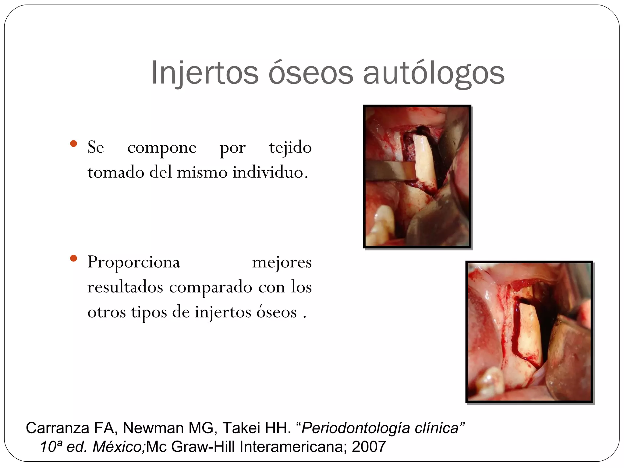 Injertos oseostema 2(auto y aloinjerto) grupo 3007 | PPT