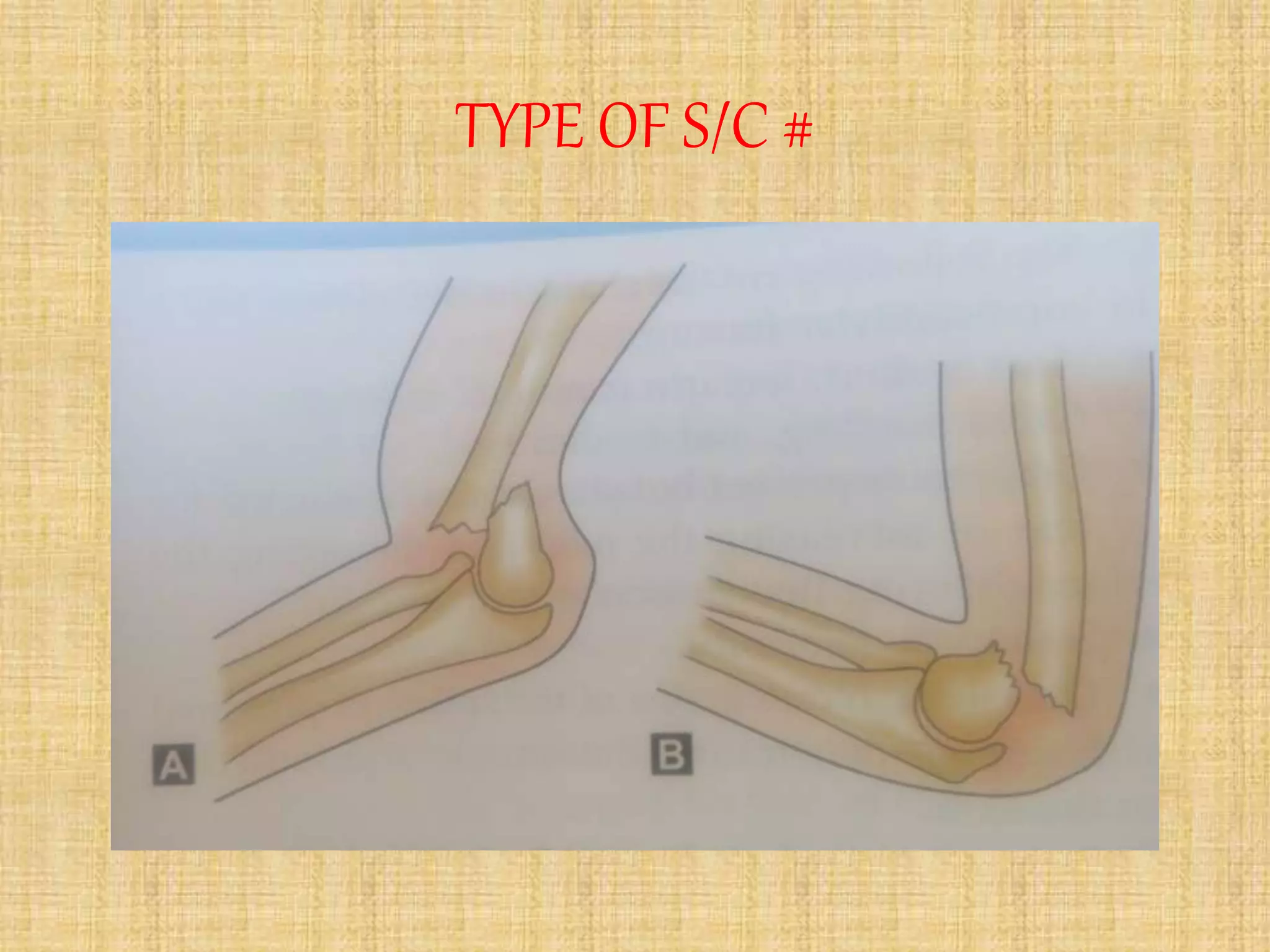 Injuries around elbow in children | PPTX