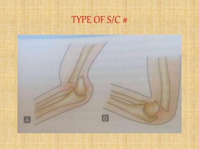 Injuries around elbow in children | PPT